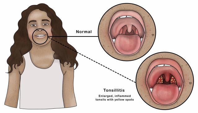 Tonsillitis Before And After